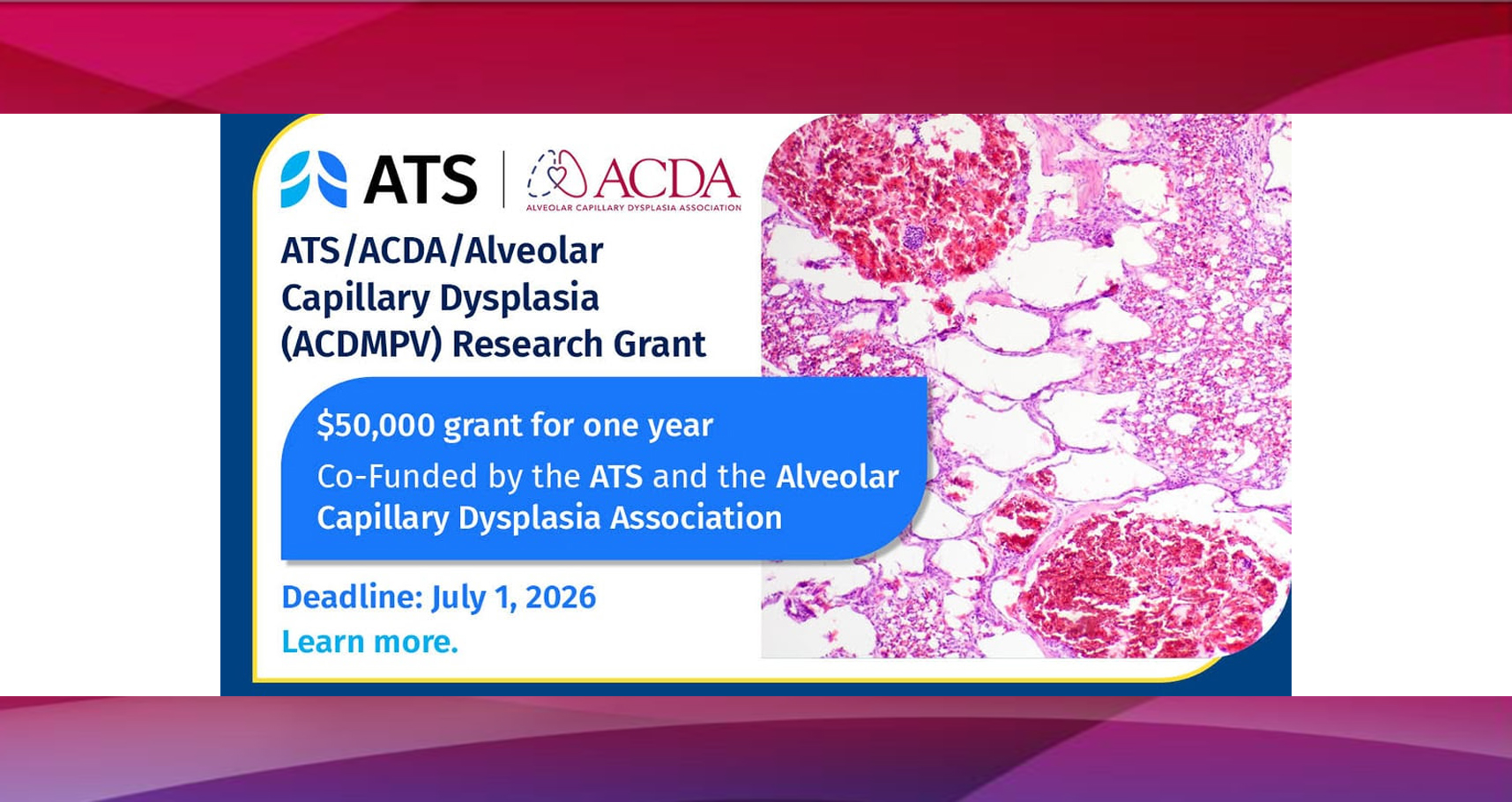 ATS/ACDA Grant Announcement | ACD Association